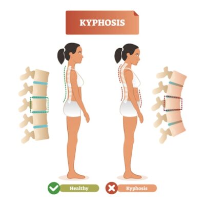 Kyphosis vs Scoliosis – Brooklyn Scoliosis Therapy