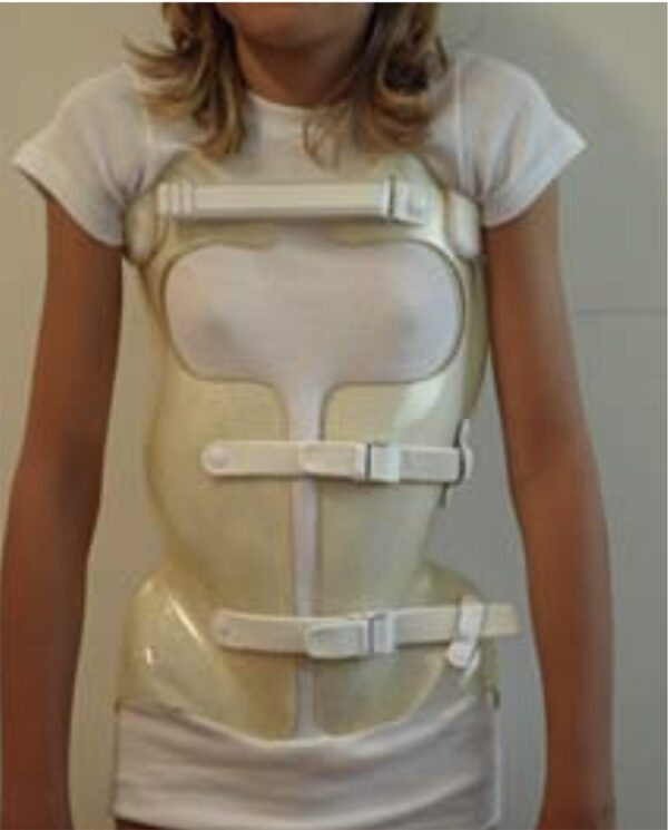 About Scoliosis Bracing – Brooklyn Scoliosis Therapy